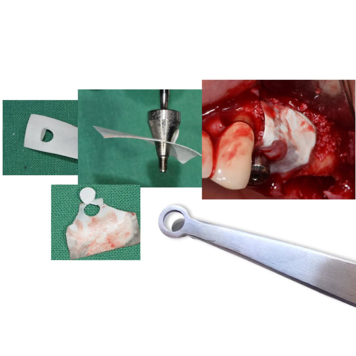 Membrane Punch | Avtec Dental