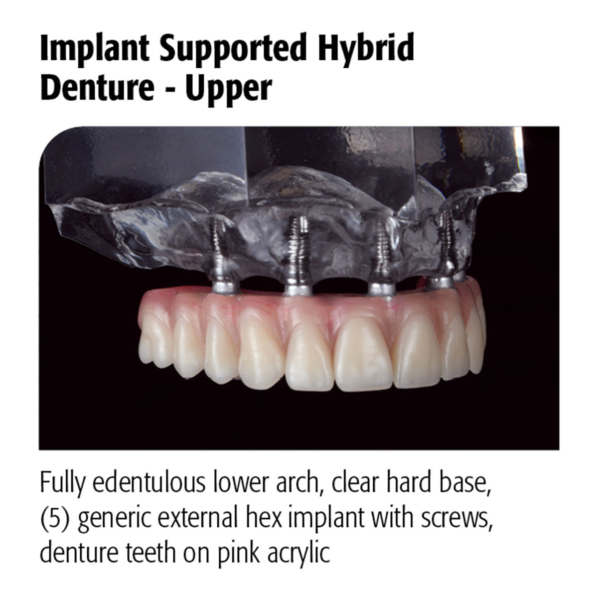 Implant Supported Hybrid Denture – Upper | Avtec Dental